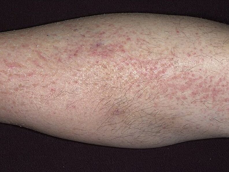 Psoriasis on the legs symptoms, stages, types, diagnosis and methods of treatment | Official ...